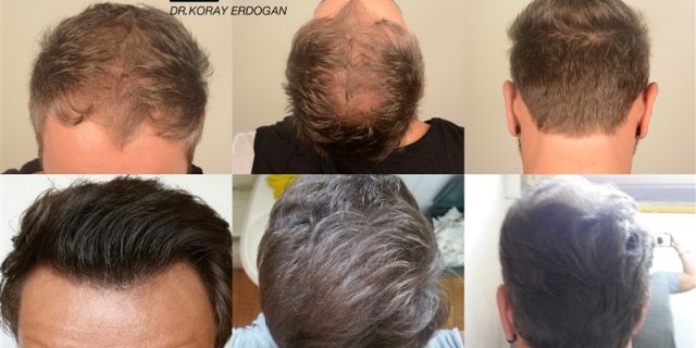 Hair Transplant in Turkey